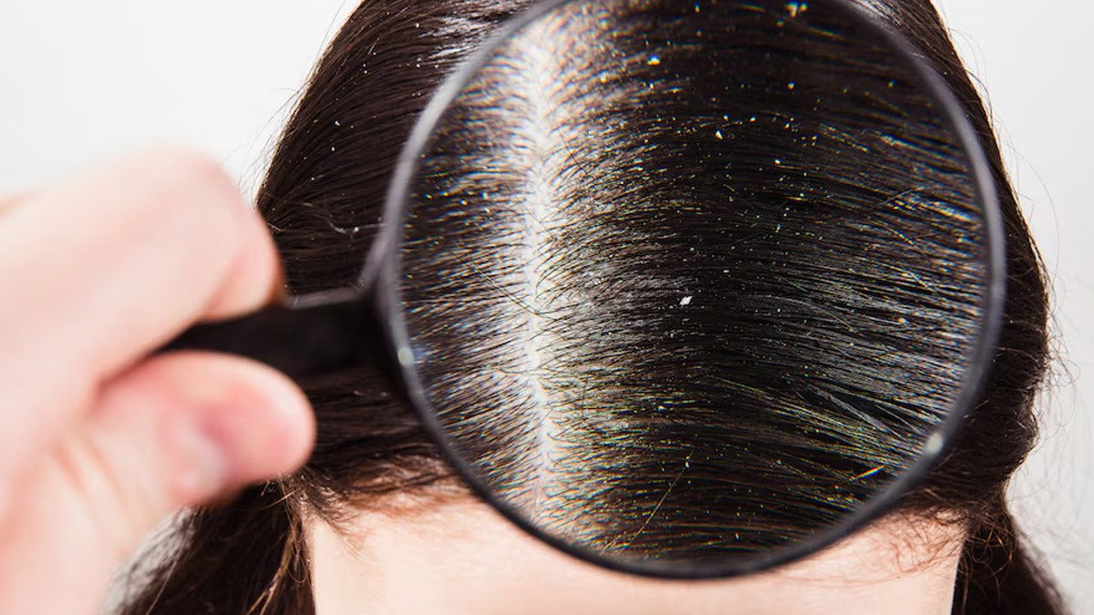 Scalp Psoriasis Vs Dandruff Expert Lists Key Differences You Should
